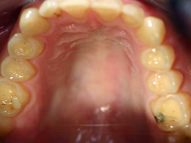 Bruxismus - Denta Beaute