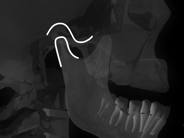 Diskusverlagerung | Denta Beaute Zahnmedizin