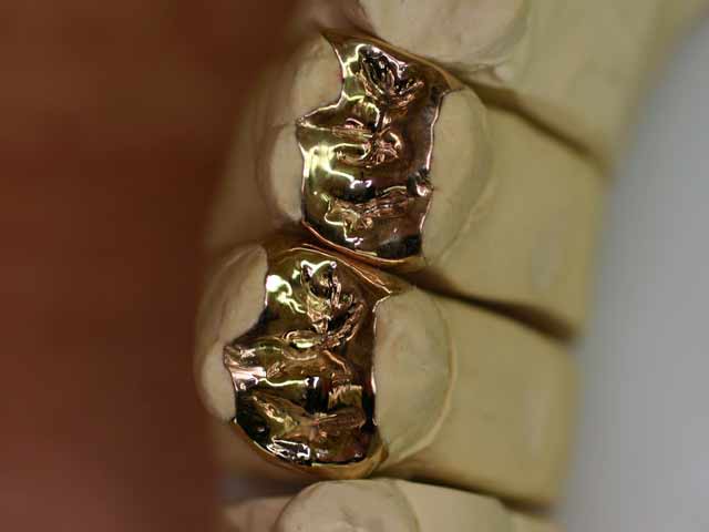 Füllungsmaterialien | Denta Beaute Zahnmedizin