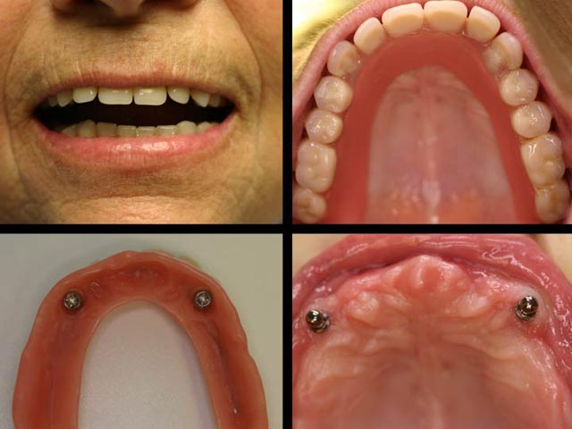 Hybridprothese - Denta Beaute