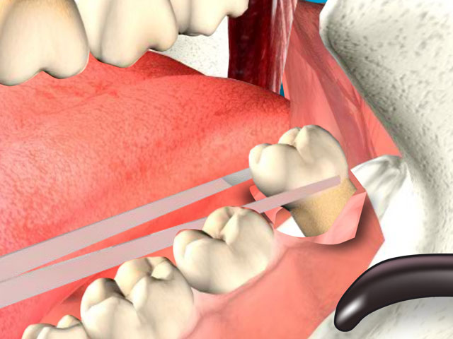 Knochentasche - Denta Beaute