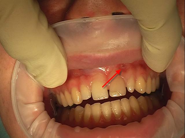 Radikuläre Zyste - Denta Beaute