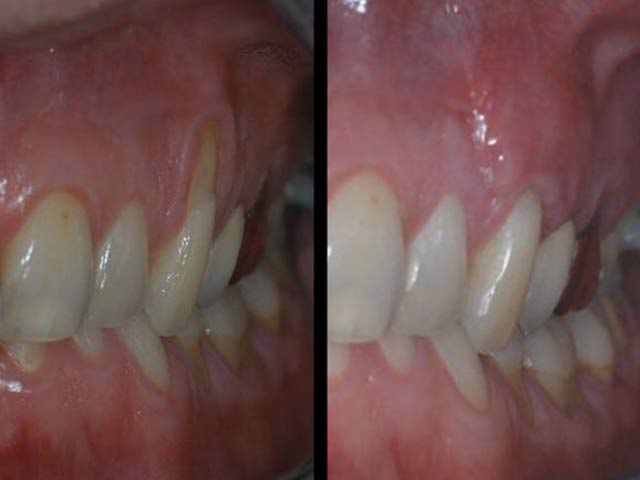 Rezessionsdeckung - Denta Beaute