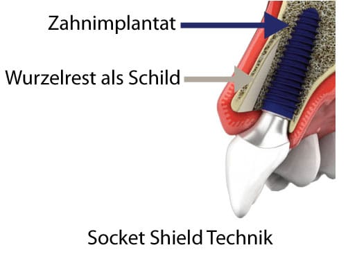 Socket Shield Technique - Denta Beaute