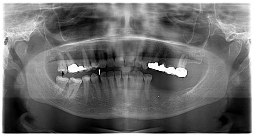 Problem mit Backenzahn und Interpretation der Röntgenbilder - Denta Beaute